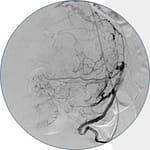 Procedures - Interventional Radiology Associates